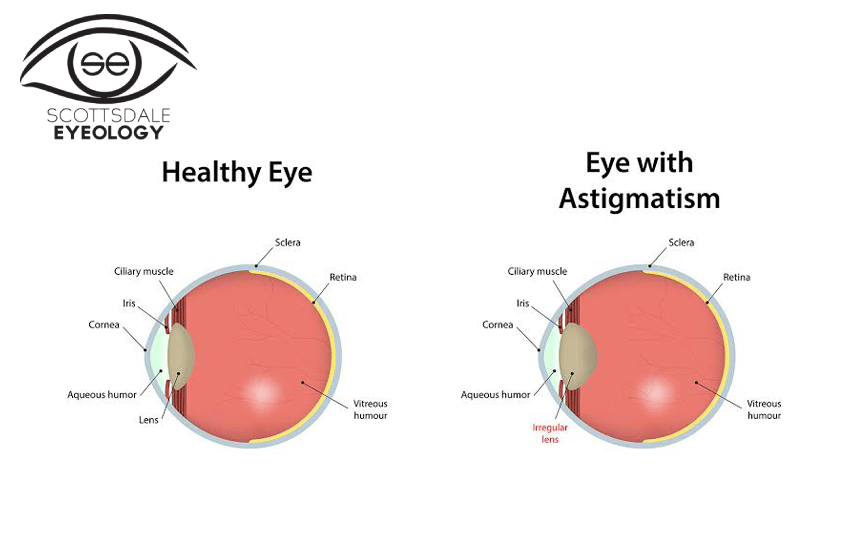 What Are Astigmatism And How It Is Treated What Are Astigmatism And How It Is Treated